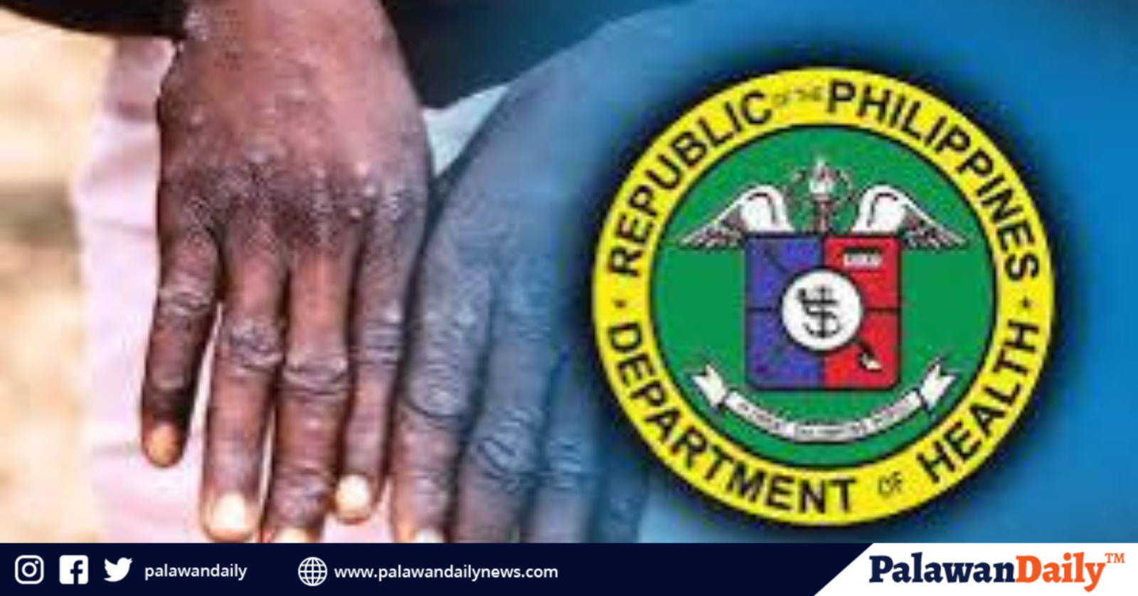 DOH: face masks not needed for mpox, no lockdown in sight